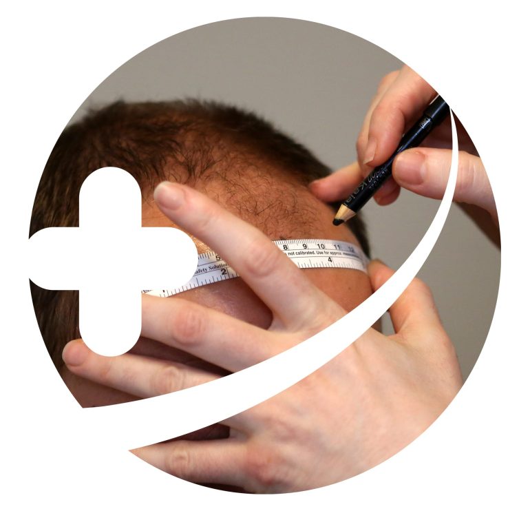 FUE TECHNIQUE - My Doctor